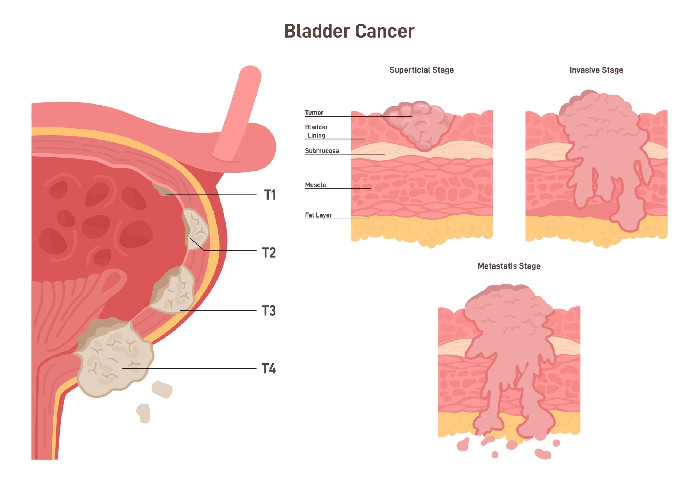 Blaaskanker :: urologienoordantwerpen